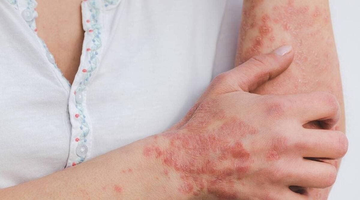 Psoriasis Skin Disease Swelling And Red Spots And Rashes On Hands And Legs Symptoms And Treatment